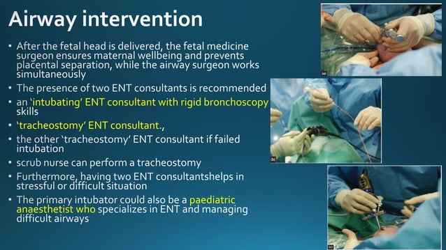 Perinatal airway management haemangiomas and vascular malformations ...