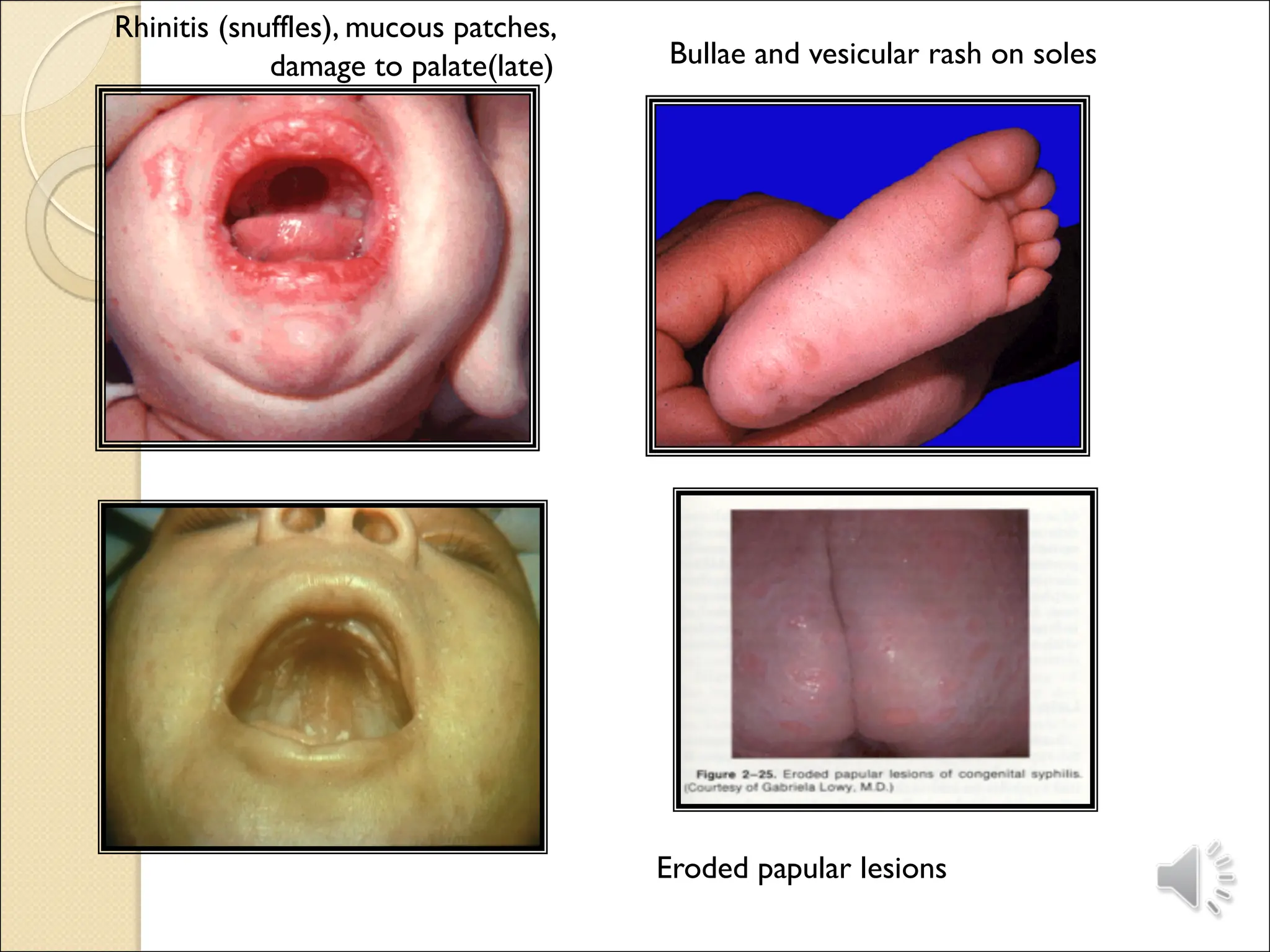 Perinatal infection tratment and complication | PPT