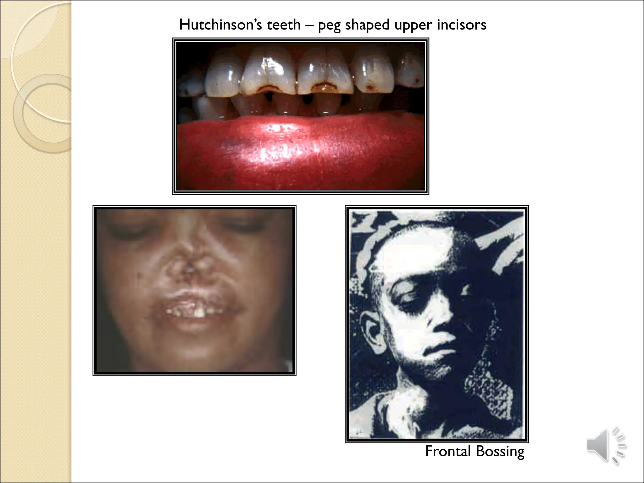 Perinatal infection tratment and complication | PPT