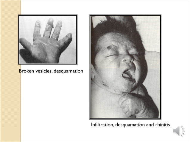 Perinatal infection tratment and complication | PPT