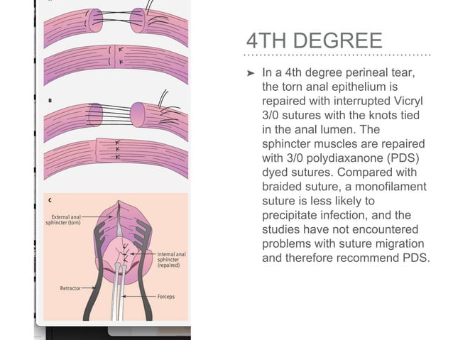 RISK FACTORS,EVALUATION AND MANAGEMENT OF PERINEAL TEARS | PPT