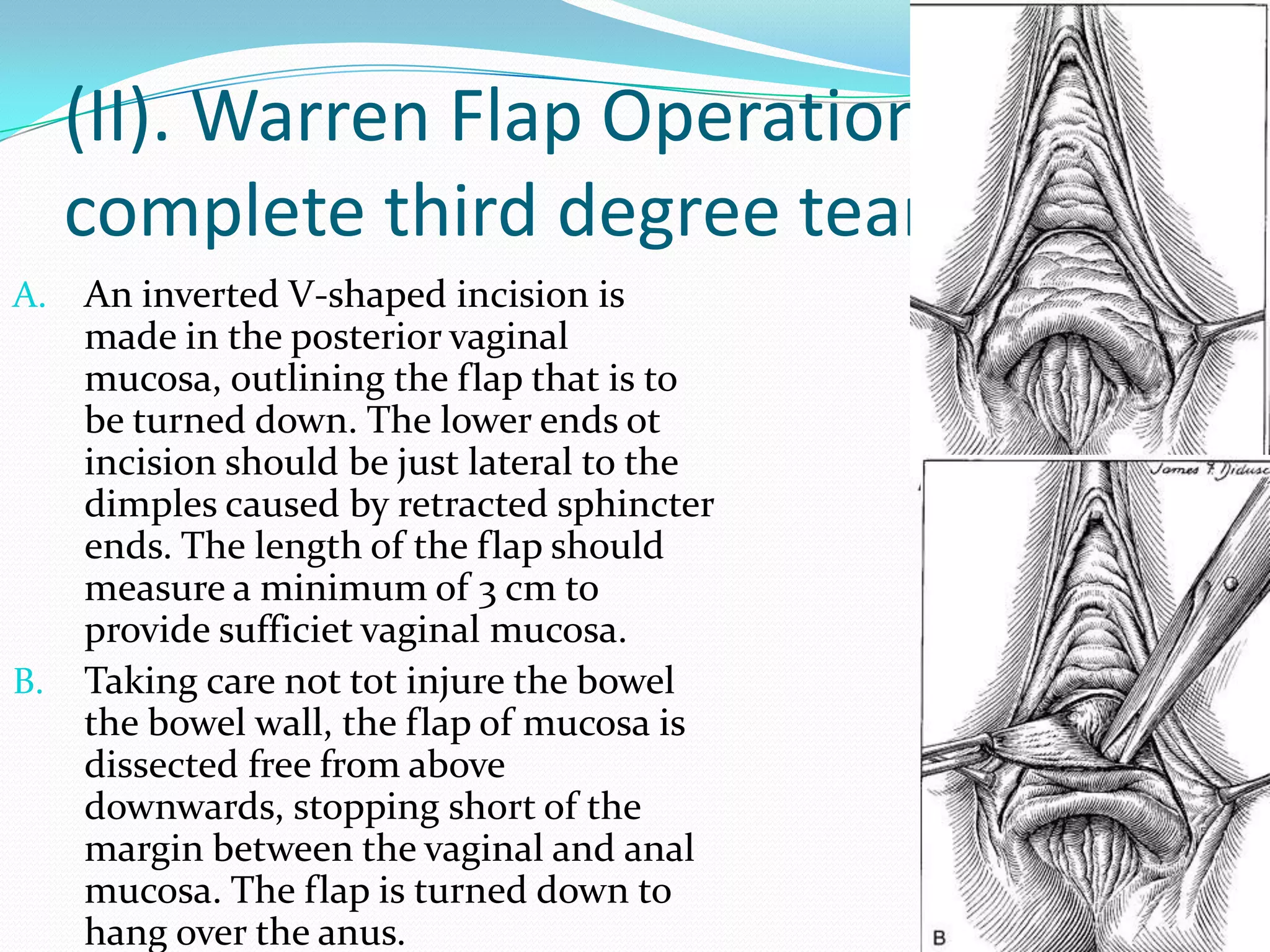 Perineal lacerations | PPTX