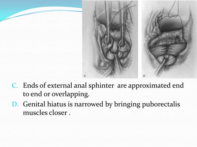 Perineal Lacerations