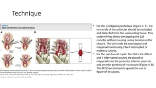 Step by Step to Perineal repair .BOY.pptx
