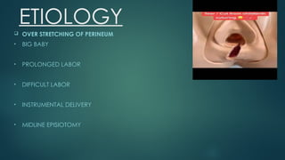 perineal tear description , types , repair and treatment | PPTX