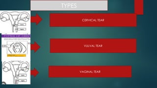 perineal tear description , types , repair and treatment | PPTX