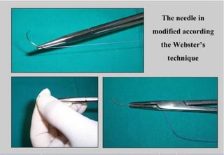 Perineal urethrostomy | PDF