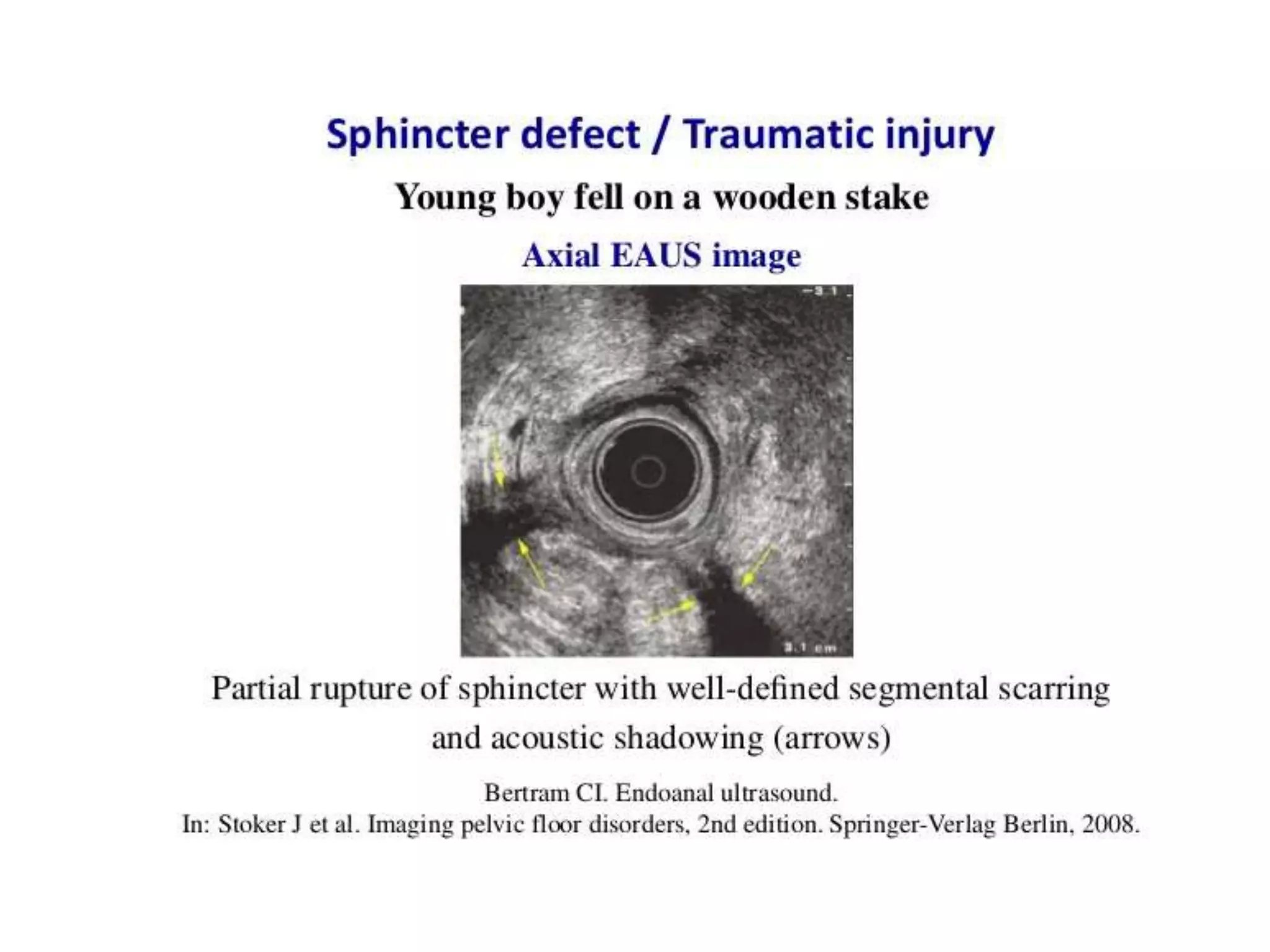 Perineal usg ravi | PPT