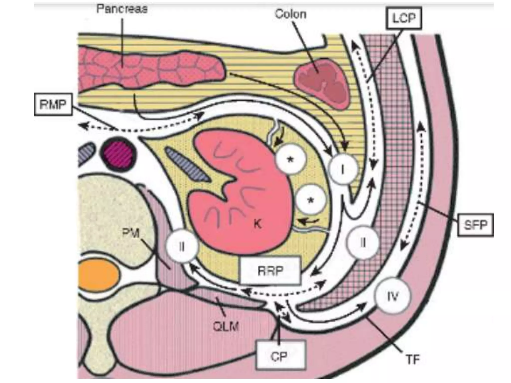 Perinephric abscess imaging | PPTX