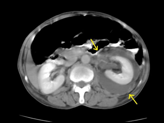Perinephric abscess imaging | PPTX | Digestive Disorders | Diseases and ...