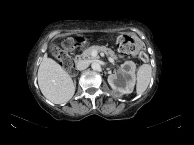 Perinephric abscess imaging | PPTX | Digestive Disorders | Diseases and ...