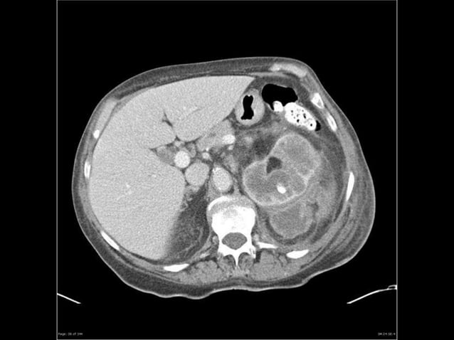 Perinephric abscess imaging | PPTX | Digestive Disorders | Diseases and ...