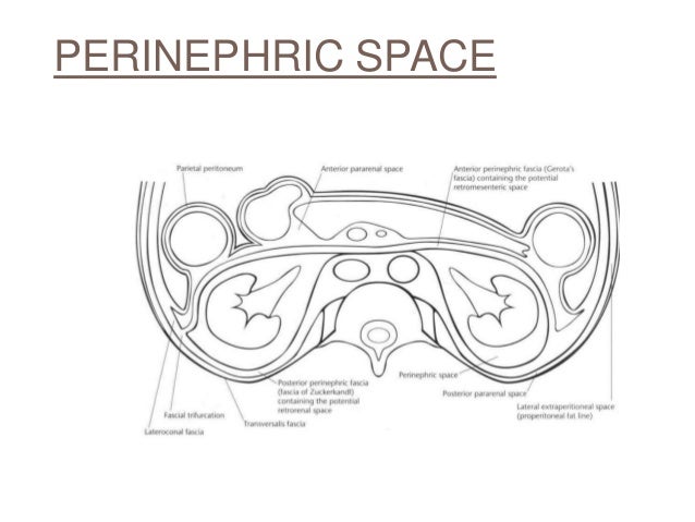Perinephric abscess imaging