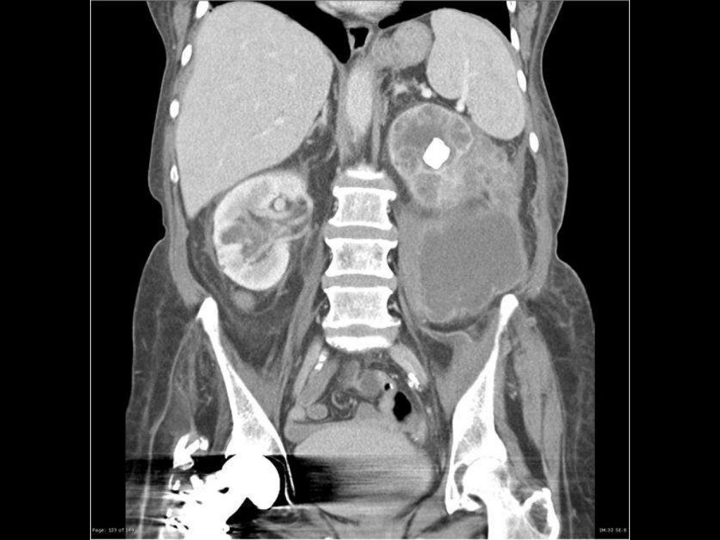 Perinephric abscess imaging