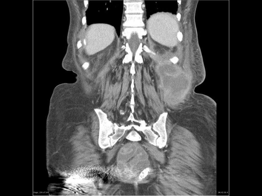 Perinephric Abscess Imaging