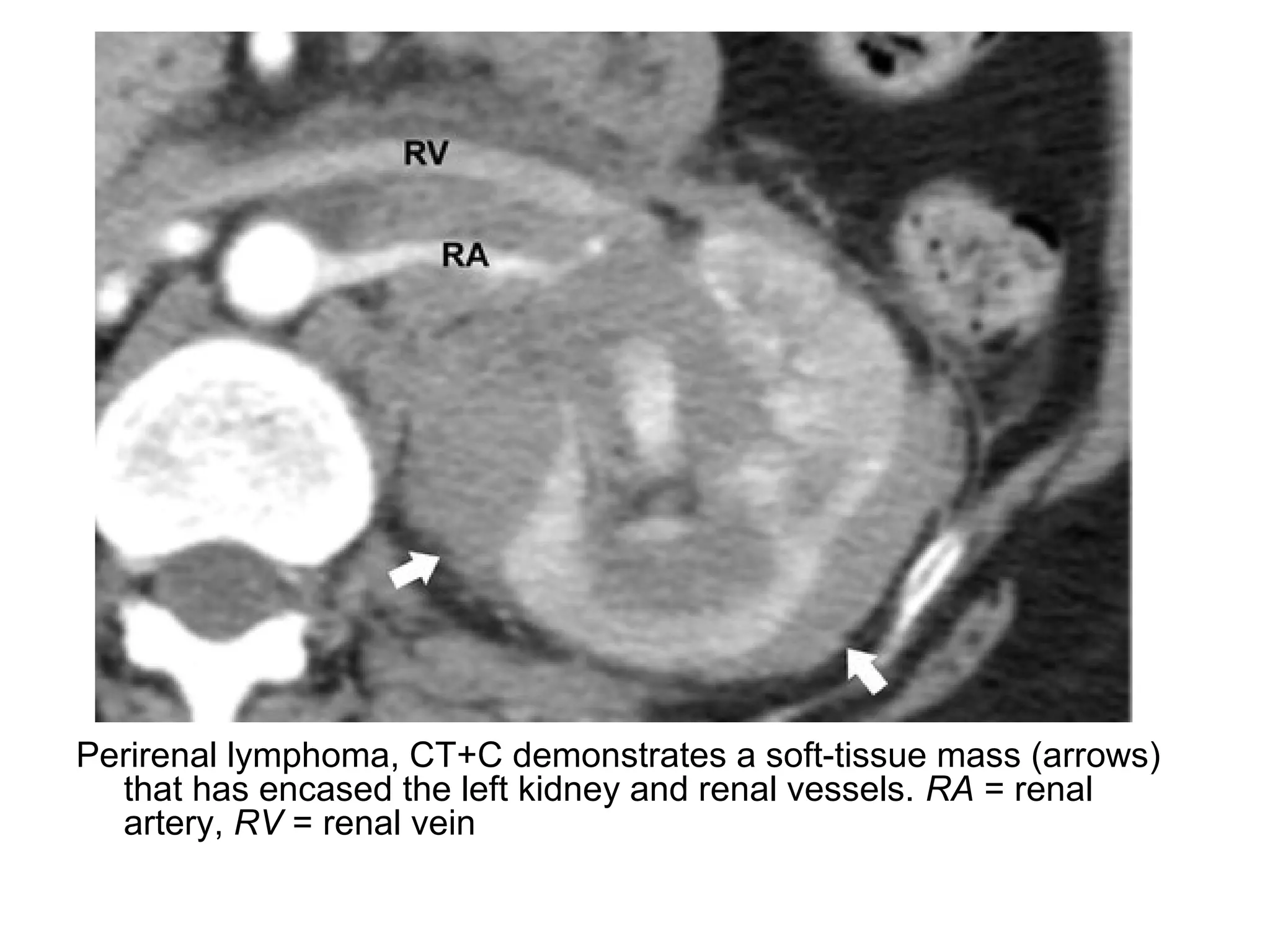 Diagnostic Imaging of Perinephric Space | PPT