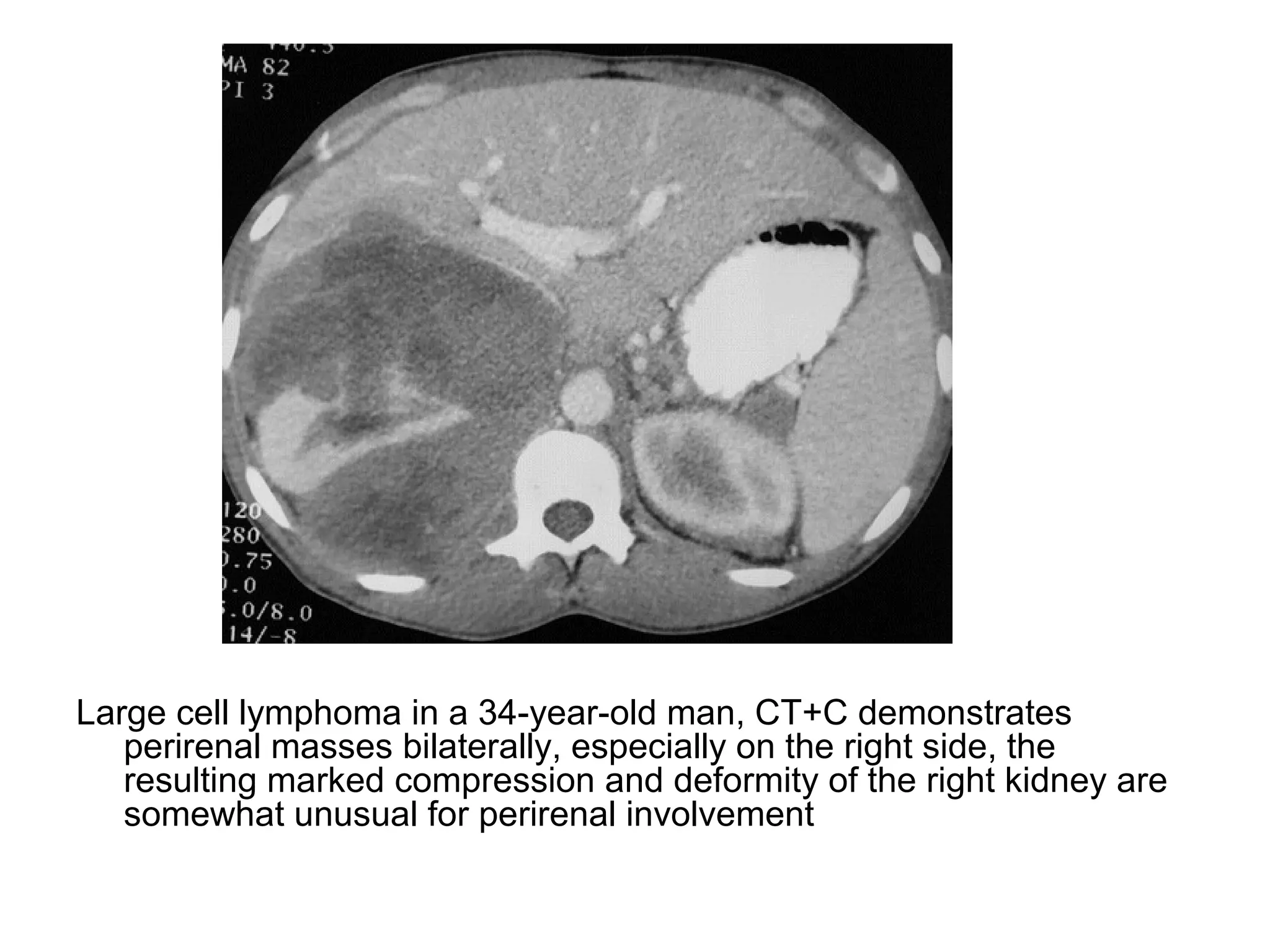 Diagnostic Imaging of Perinephric Space | PPT
