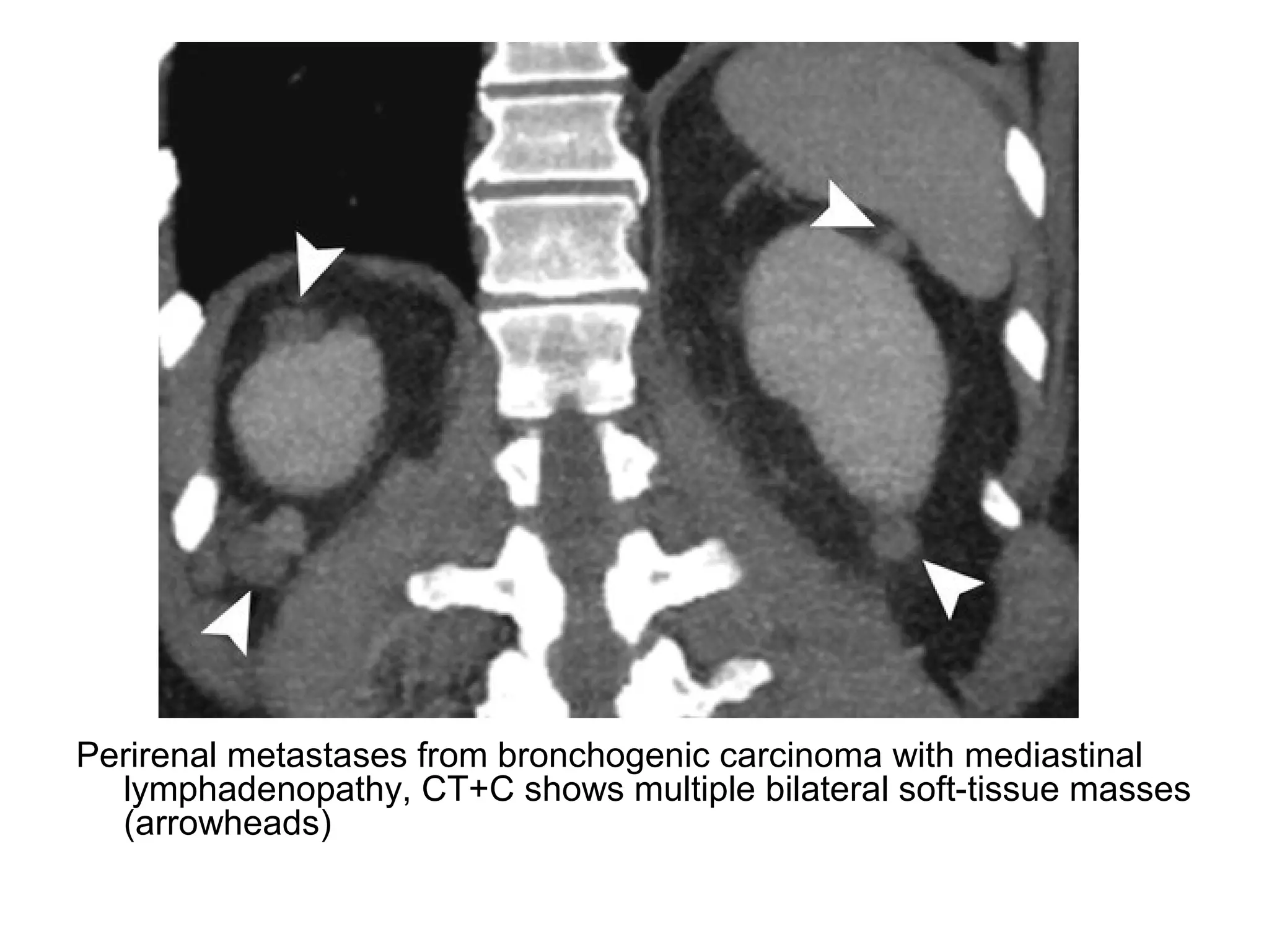 Diagnostic Imaging of Perinephric Space | PPT