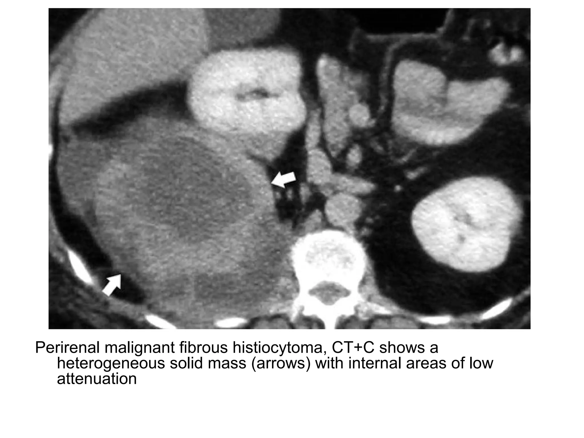 Diagnostic Imaging of Perinephric Space | PPT