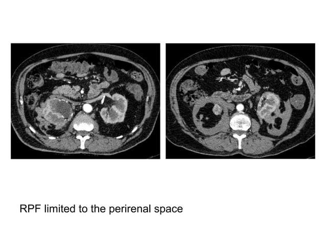 Diagnostic Imaging of Perinephric Space | PPT