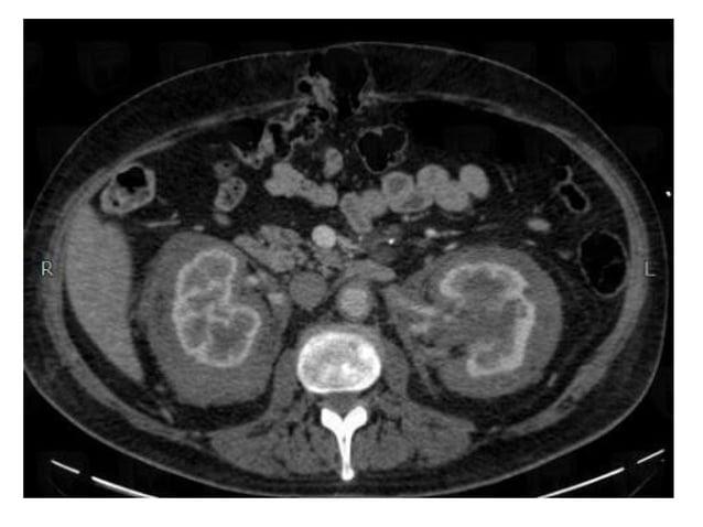 Diagnostic Imaging of Perinephric Space | PPT