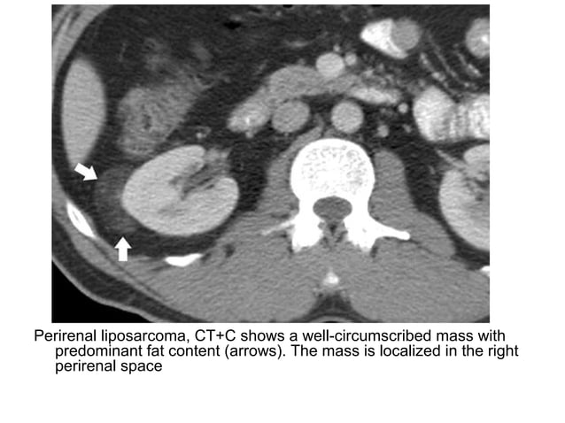 Diagnostic Imaging of Perinephric Space | PPT