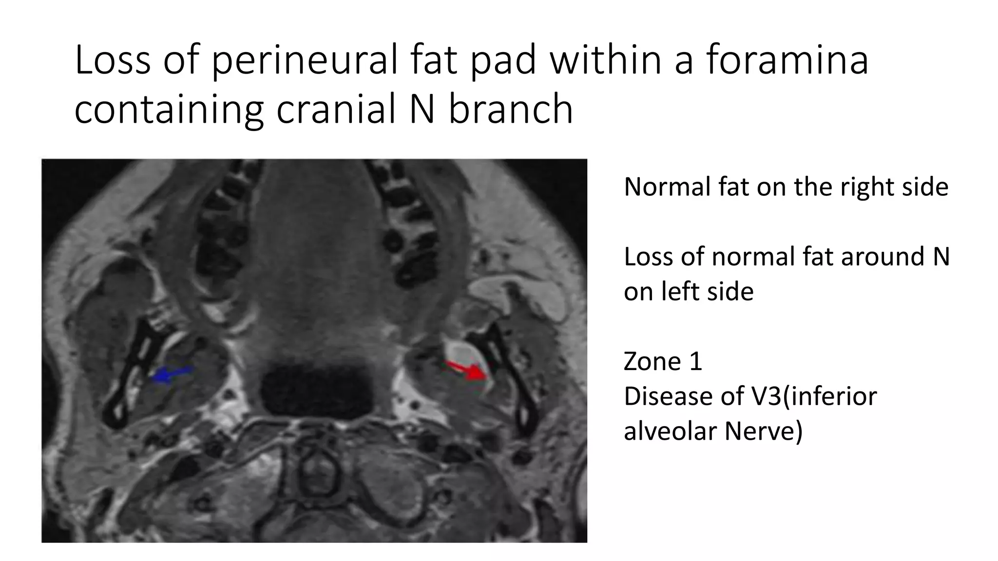 Perineural invasion head neck cancers radiation therapy volumes and ...