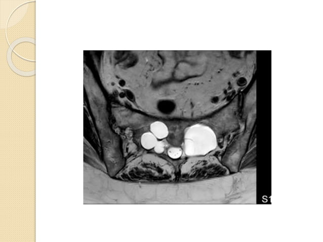 Perineural cysts | PPTX | Brain and Nervous System Disorders | Diseases ...