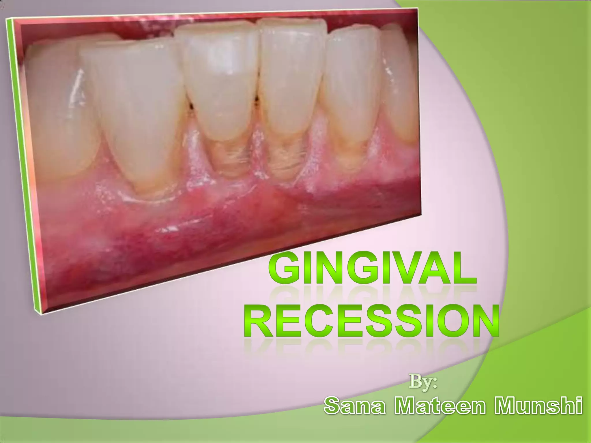 Gingival Recession | PPTX