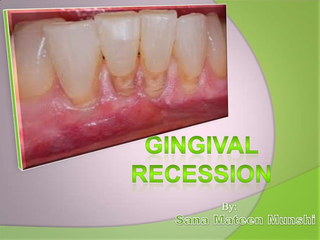 Gingival Recession | PPT
