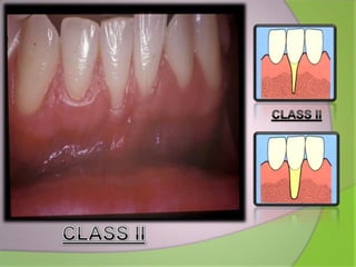 Gingival Recession | PPT