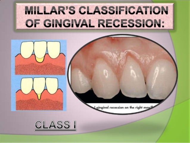Gingival Recession