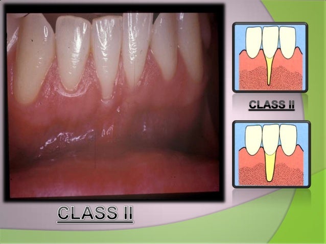Gingival Recession