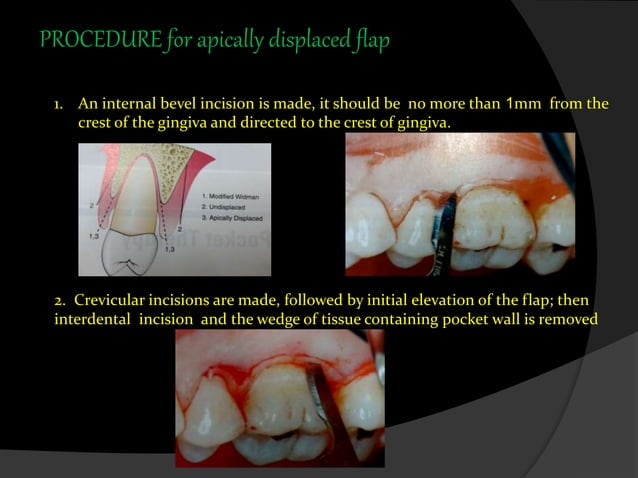 Periodontal Flap | PPTX