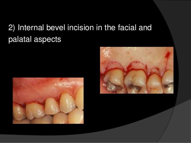 Periodontal Flap