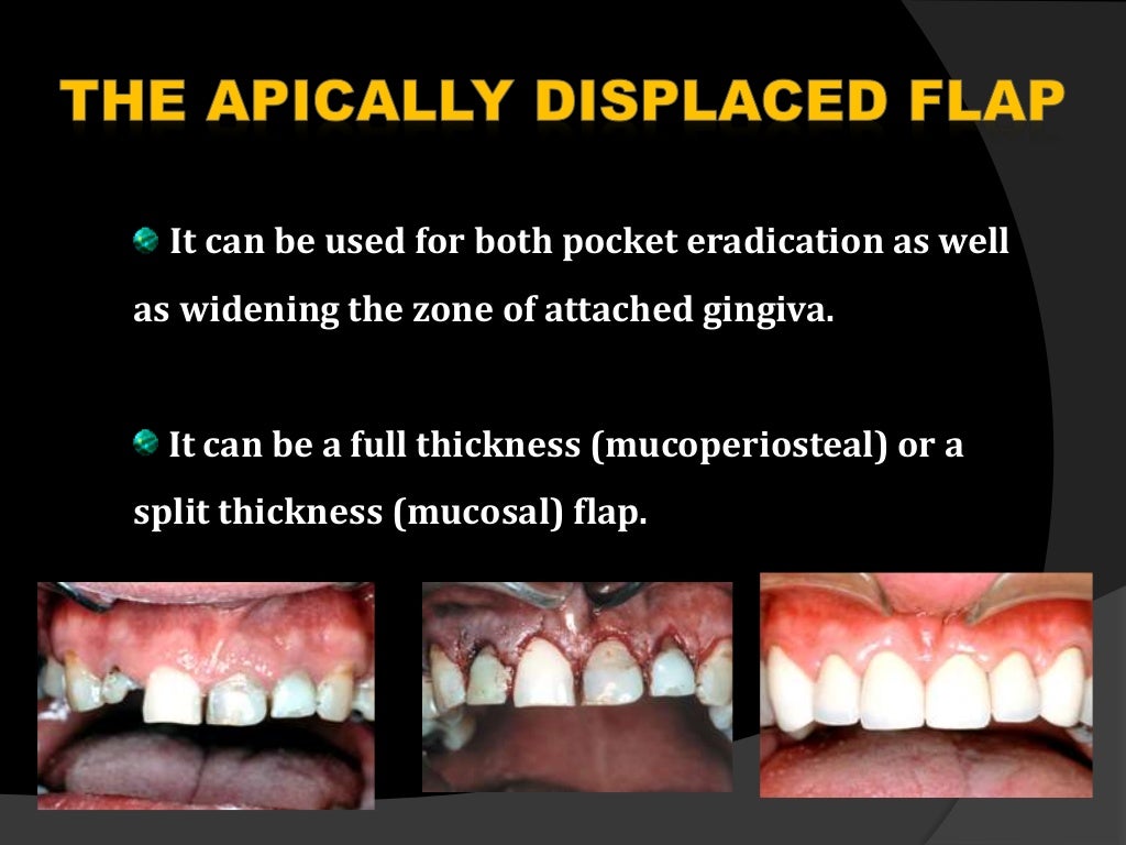 Periodontal Flap