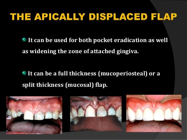 Periodontal Flap