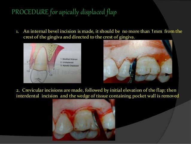 Periodontal Flap