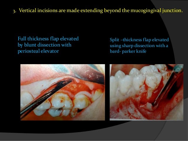 Periodontal Flap