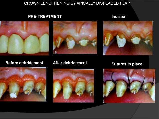 Periodontal Flap
