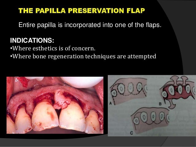 Periodontal Flap