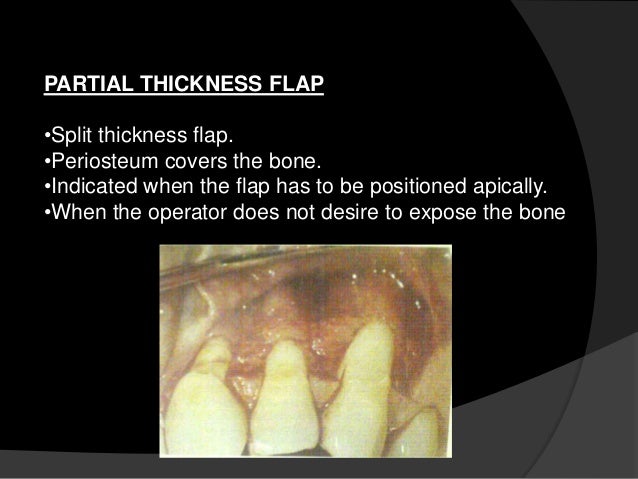Periodontal Flap