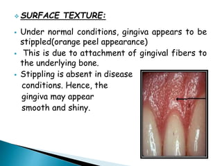 Gingival inflammation & clinical features of gingivitis | PPTX
