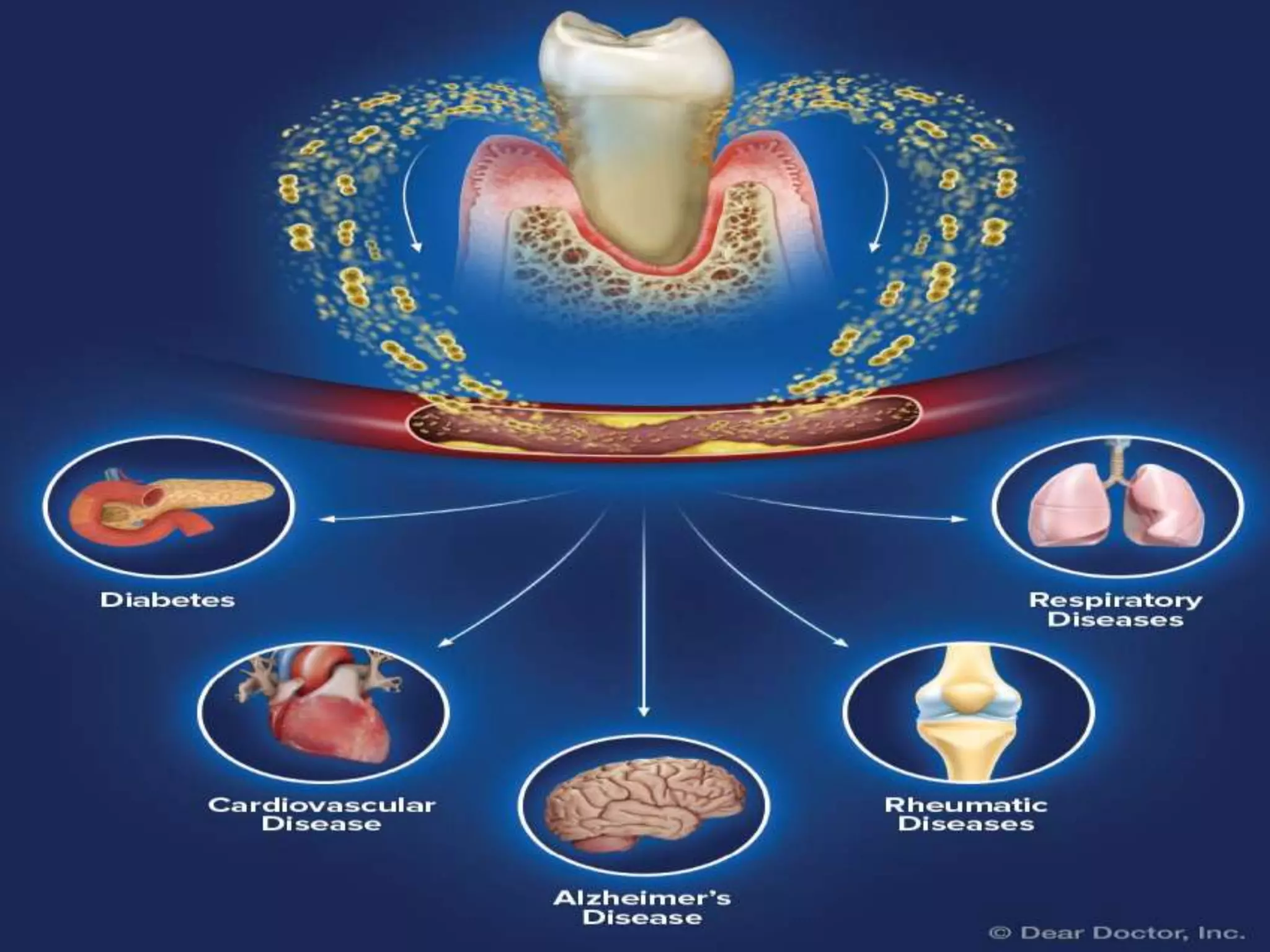 Periodontitis as a manifestation of systemic diseases | PPTX