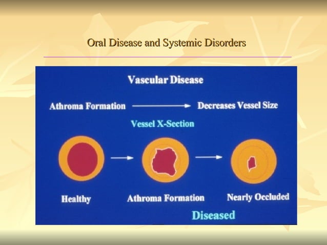Perio And Cvd | PPT | Heart and Cardiovascular Diseases | Diseases and ...