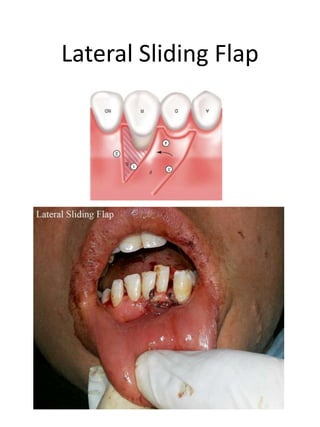 Perio surgery | PPTX