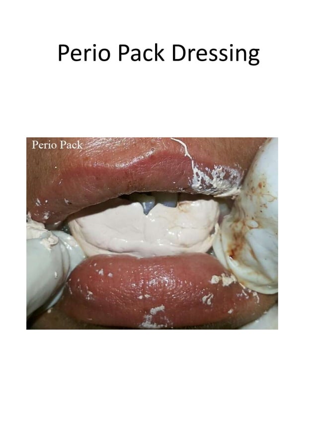 Perio surgery | PPTX