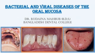Viral and Bacterial Diseases of the oral mucosa.pptx