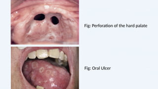Viral and Bacterial Diseases of the oral mucosa.pptx