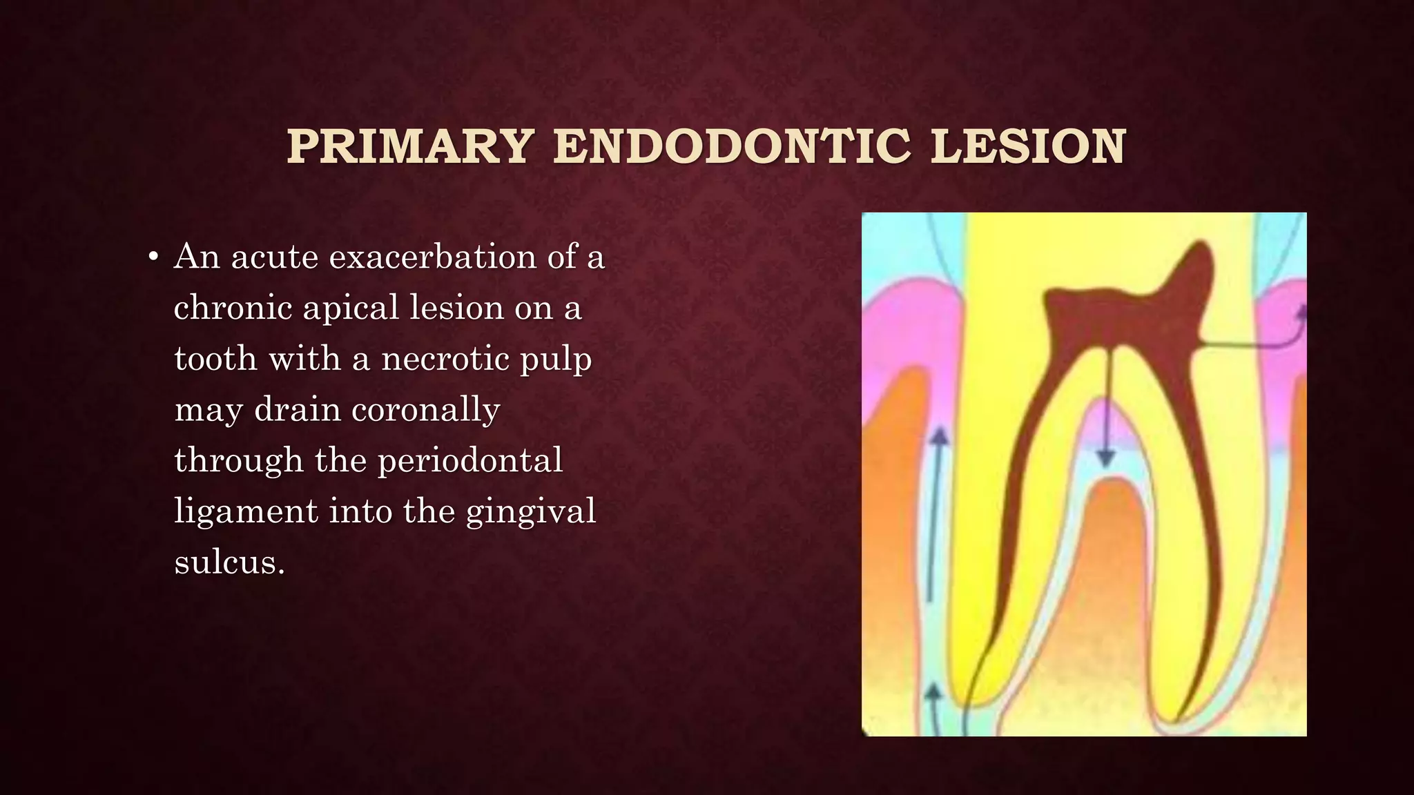 Endo-Perio Lesions | PPTX